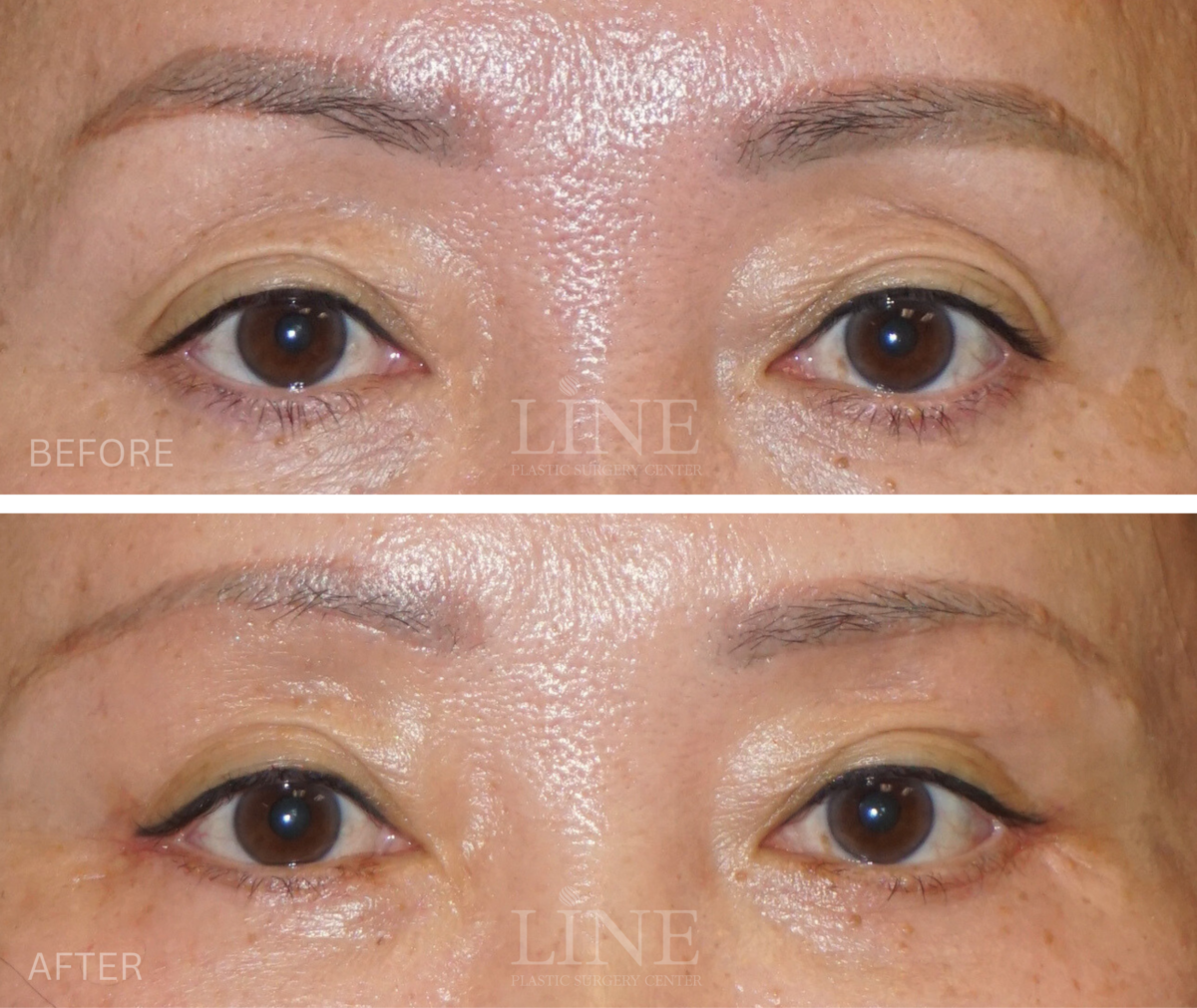 Gallery - Below Brow Lift - Line Plastic Surgery Center
