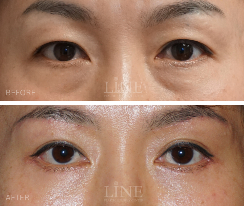 Gallery - Lower Eyelid Best Plastic Surgeon in LA | Line Plastic ...