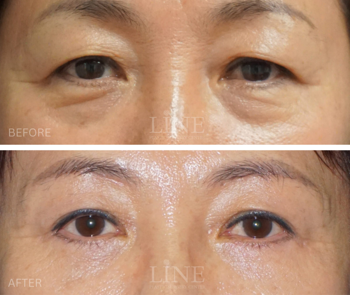 Gallery - Lower Eyelid Best Plastic Surgeon in LA | Line Plastic ...