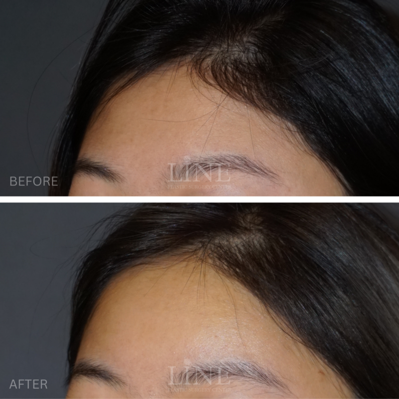 Gallery - Forehead Skull Reshaping Before & After Photos