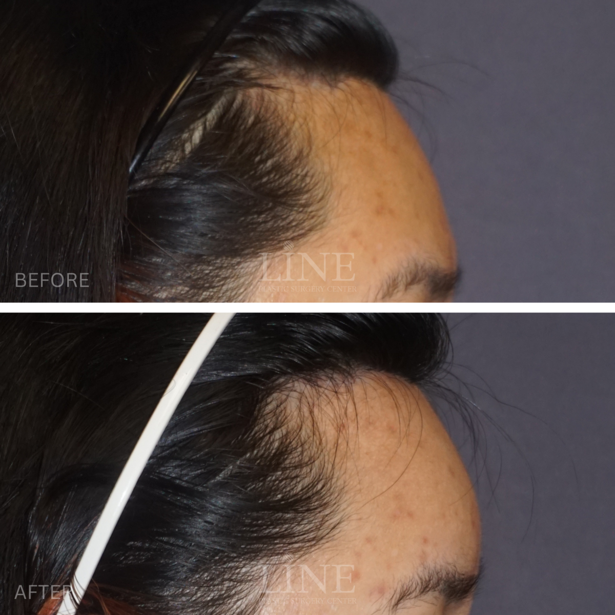 Gallery - Forehead Skull Reshaping Before & After Photos