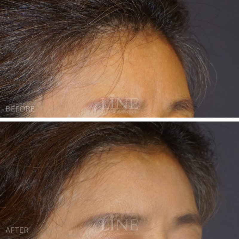 Gallery - Forehead Skull Reshaping Before & After Photos