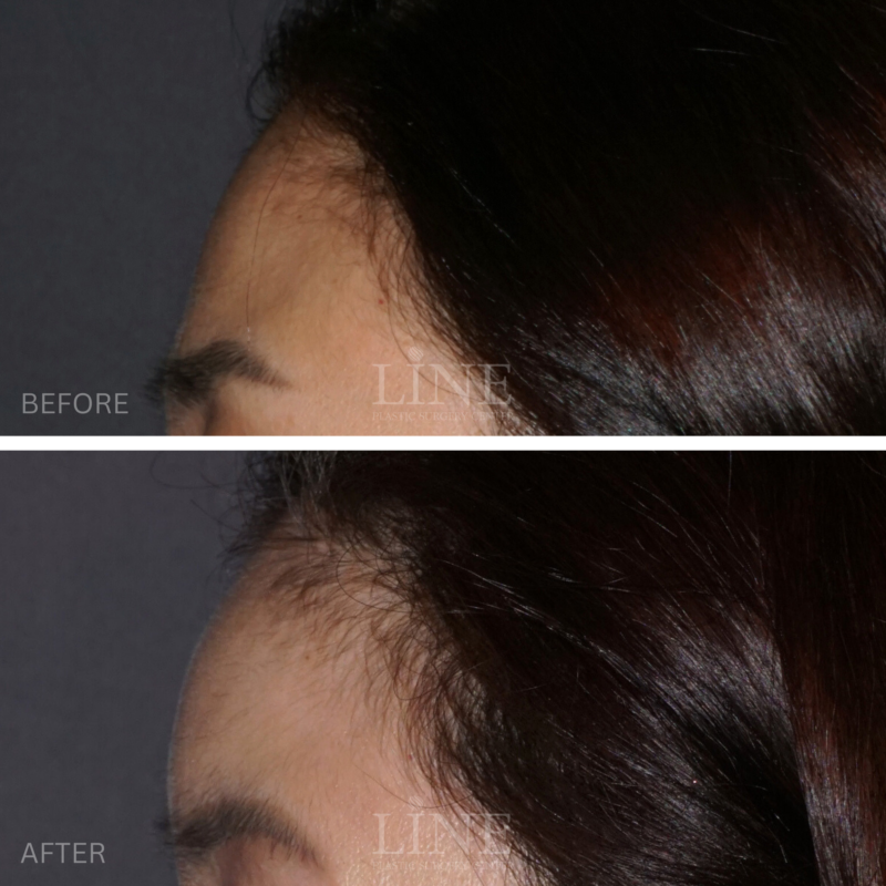 Gallery - Forehead Skull Reshaping Before & After Photos