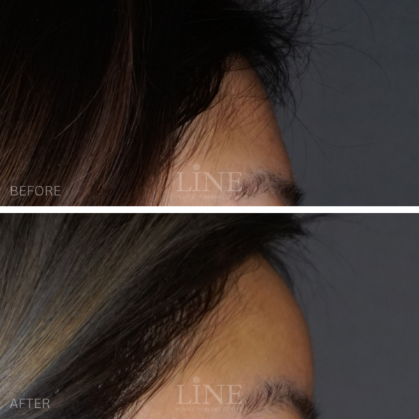 Gallery - Forehead Skull Reshaping Before & After Photos