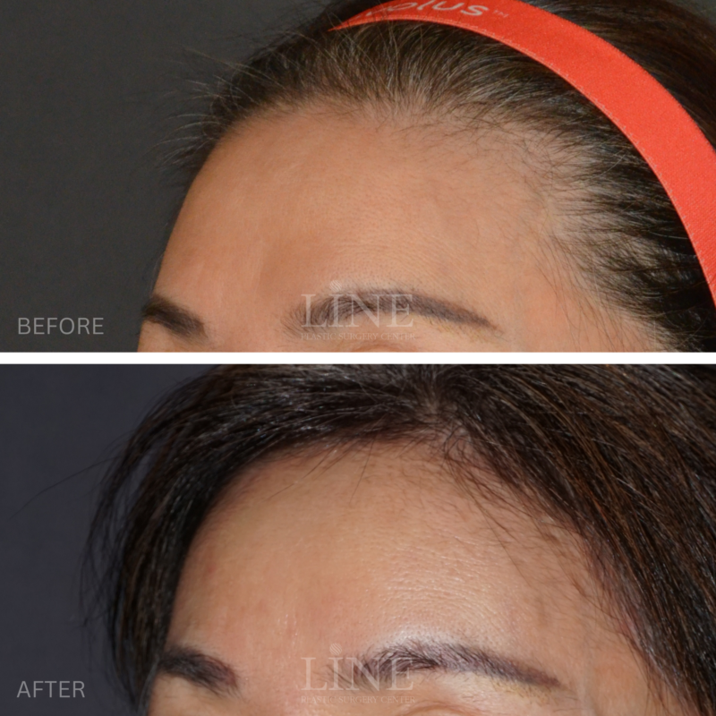 Gallery - Forehead Skull Reshaping Before & After Photos