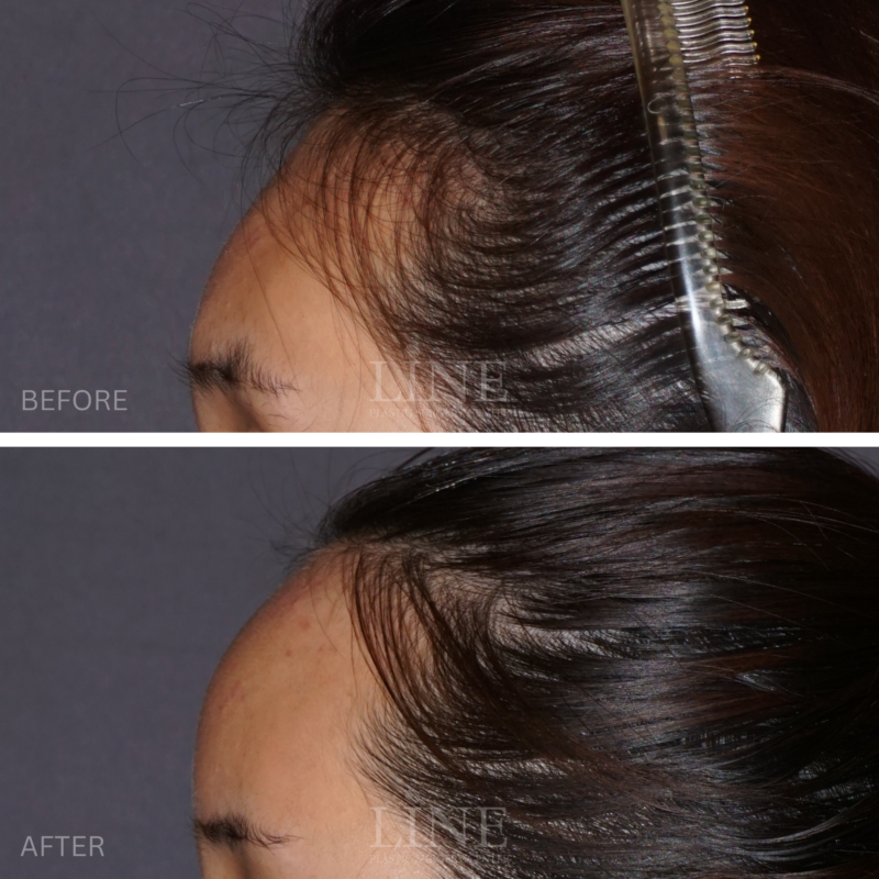 Gallery - Forehead Skull Reshaping Before & After Photos
