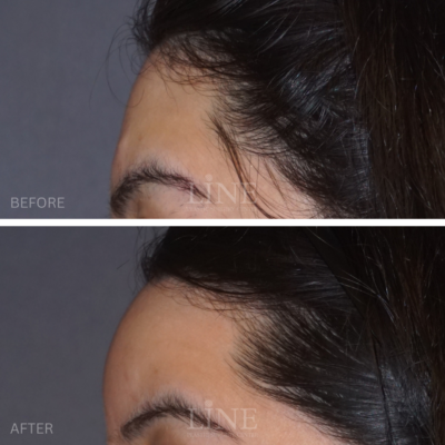 Gallery - Forehead Skull Reshaping Before & After Photos