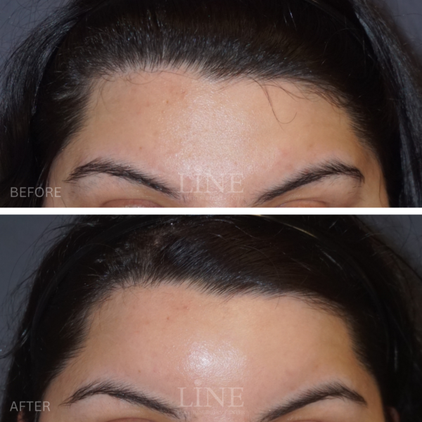 Gallery - Forehead Skull Reshaping Before & After Photos