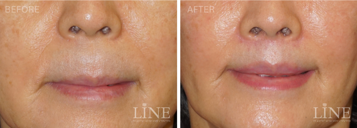 Gallery - Upper Lip Lift Best Plastic Surgeon in LA | Line Plastic ...